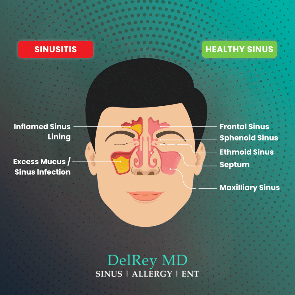 Stop Sinusitis Marina Del Rey - Sinusitis Treatment Los Angeles